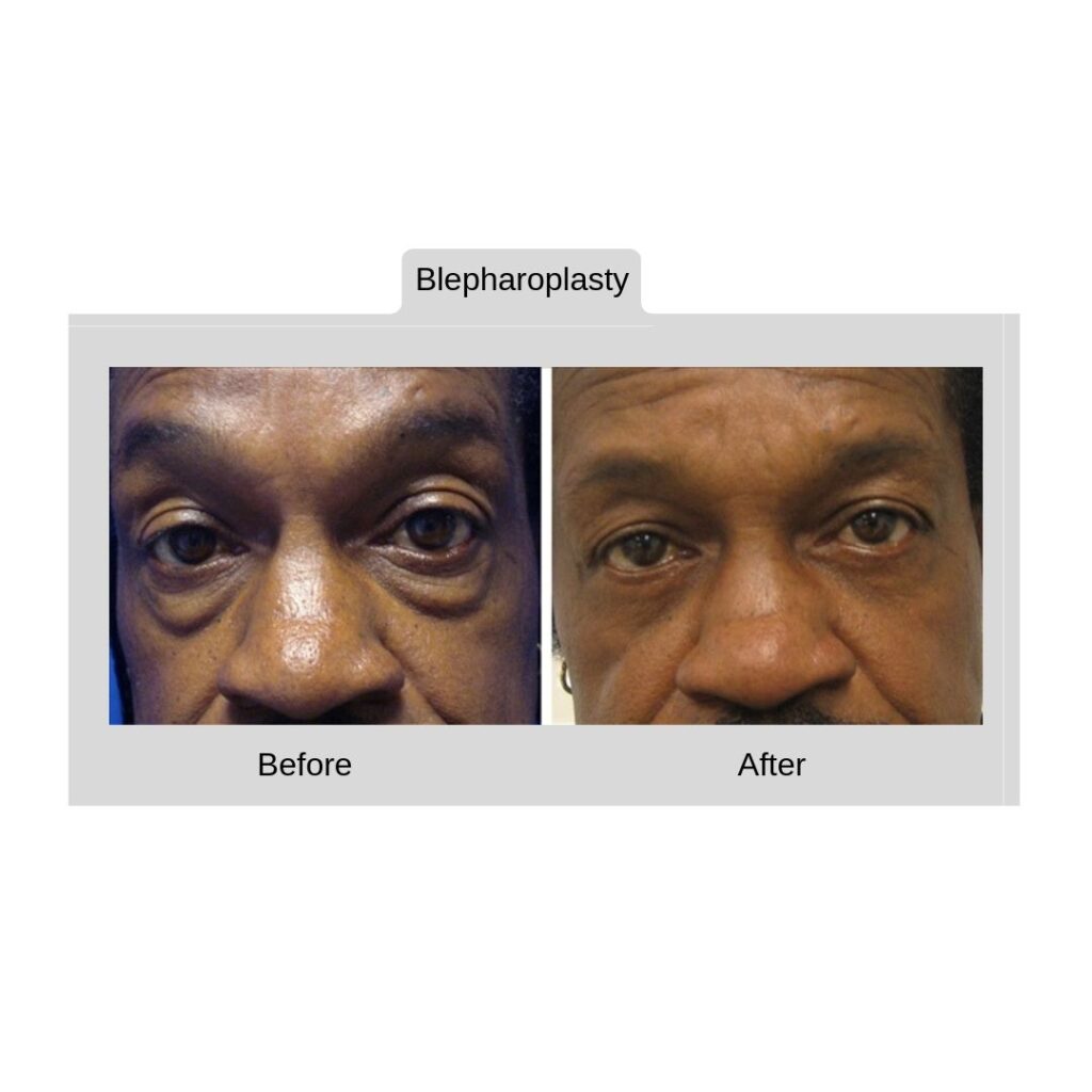 What Is Blepharoplasty and How Can I Benefit From It? - Denver Cosmetic ...