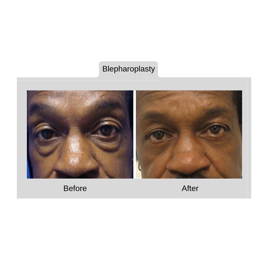 What Is Blepharoplasty and How Can I Benefit From It? - Denver Cosmetic ...