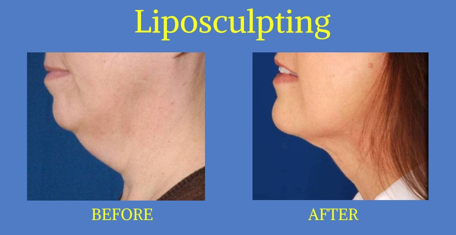 Liposculpting for a Slimmer Appearance | Edmon P. Khoury MD