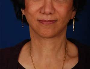 1 Week Post-Op Before & After - Denver Cosmetic Surgery - Board ...