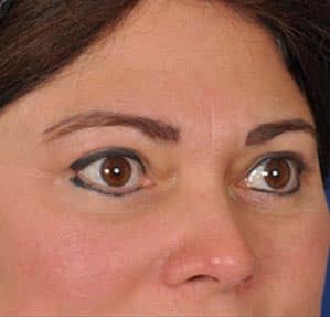 Case #3457 - Denver Cosmetic Surgery - Board Certified Plastic Surgeon