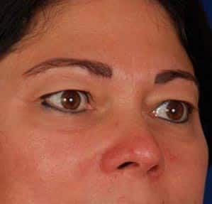 Case #3457 - Denver Cosmetic Surgery - Board Certified Plastic Surgeon