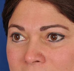 Case #3457 - Denver Cosmetic Surgery - Board Certified Plastic Surgeon