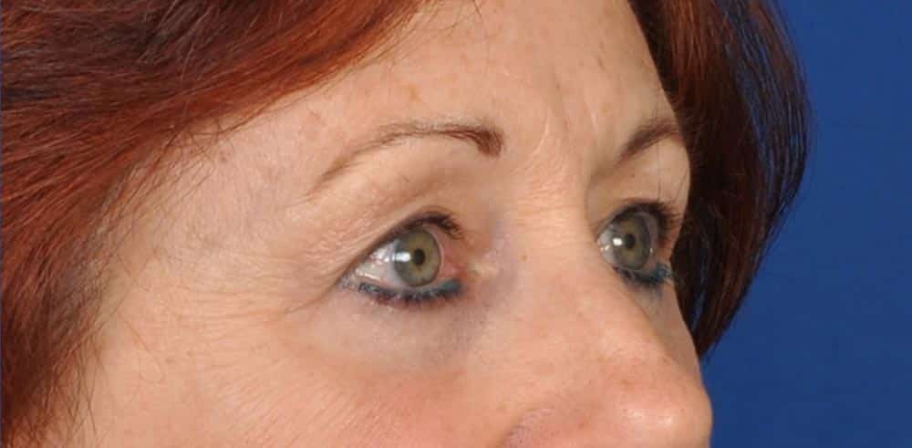 Case #1399 - Denver Cosmetic Surgery - Board Certified Plastic Surgeon