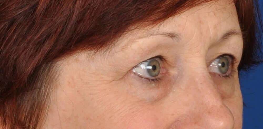 Case #1399 - Denver Cosmetic Surgery - Board Certified Plastic Surgeon