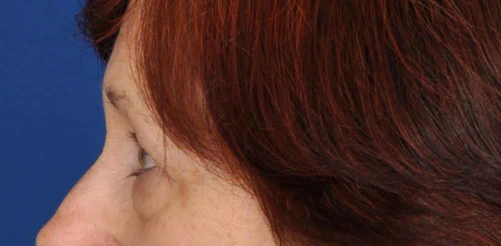 Case #1399 - Denver Cosmetic Surgery - Board Certified Plastic Surgeon