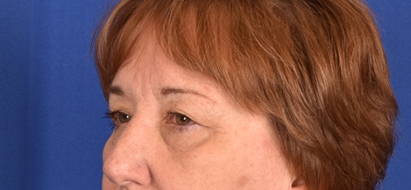 Case #9728 - Denver Cosmetic Surgery - Board Certified Plastic Surgeon