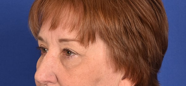 Case #9728 - Denver Cosmetic Surgery - Board Certified Plastic Surgeon