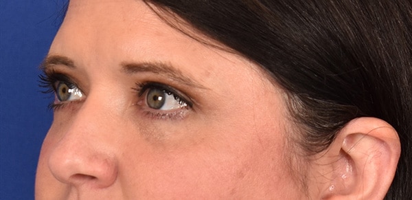 Case #5172 - Denver Cosmetic Surgery - Board Certified Plastic Surgeon