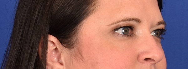 Case #5172 - Denver Cosmetic Surgery - Board Certified Plastic Surgeon