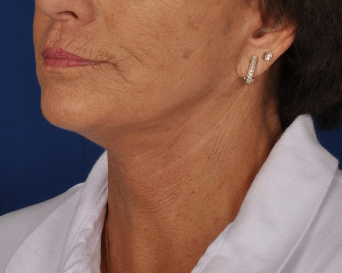 Case #1320 - Denver Cosmetic Surgery - Board Certified Plastic Surgeon