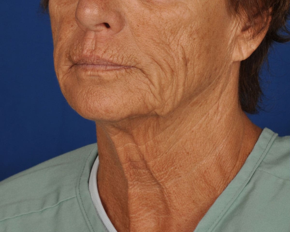 Case #1320 - Denver Cosmetic Surgery - Board Certified Plastic Surgeon