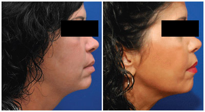 Smartlifting | Denver, CO | Edmon P. Khoury MD